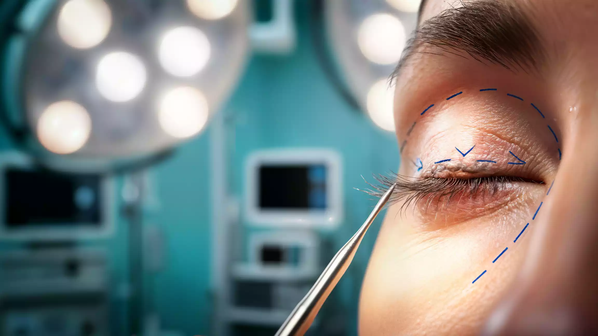 Blefaroplastia - Más Visión